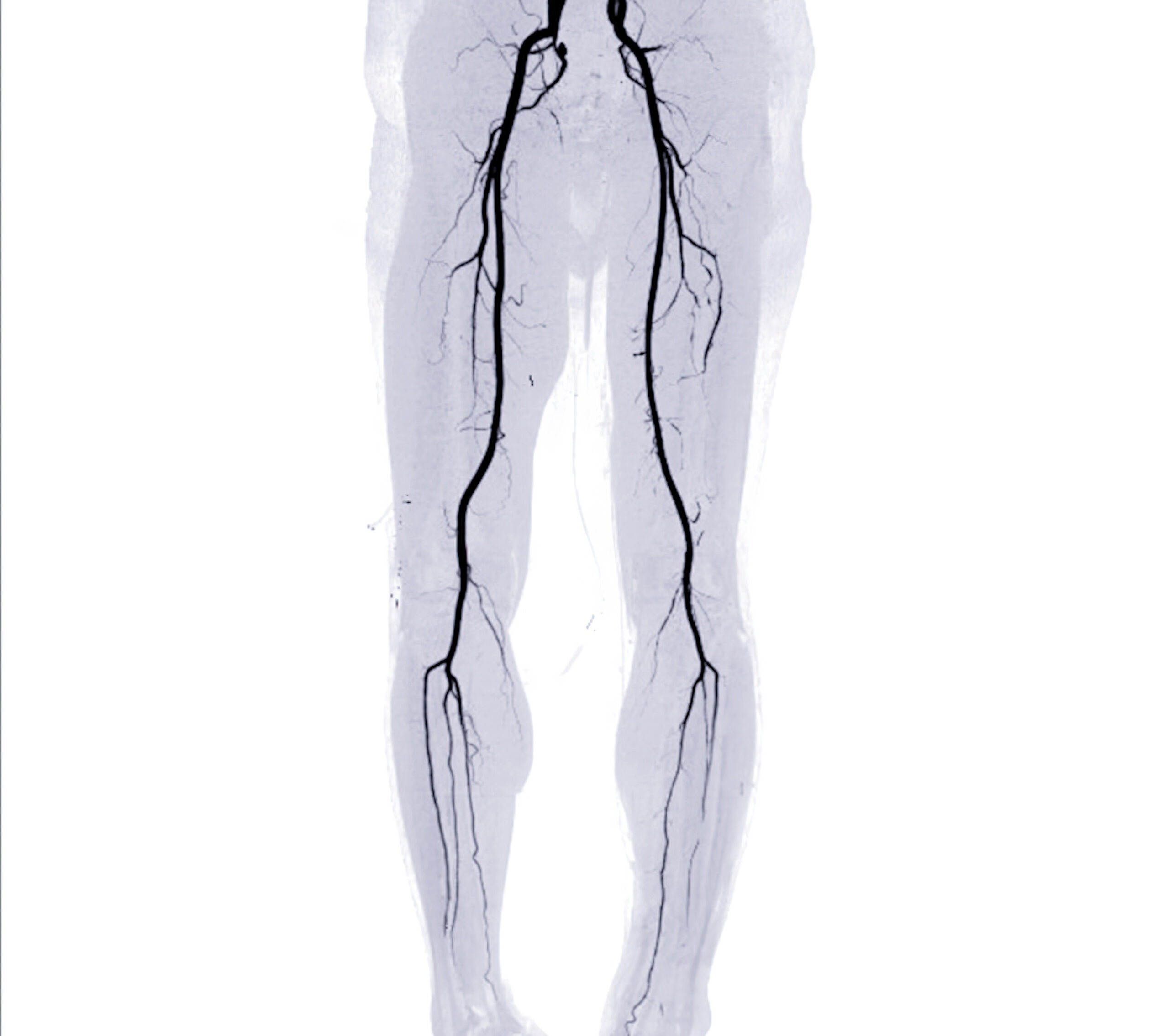 Peripheral Artery Disease (PAD) Treatment in Cary, NC