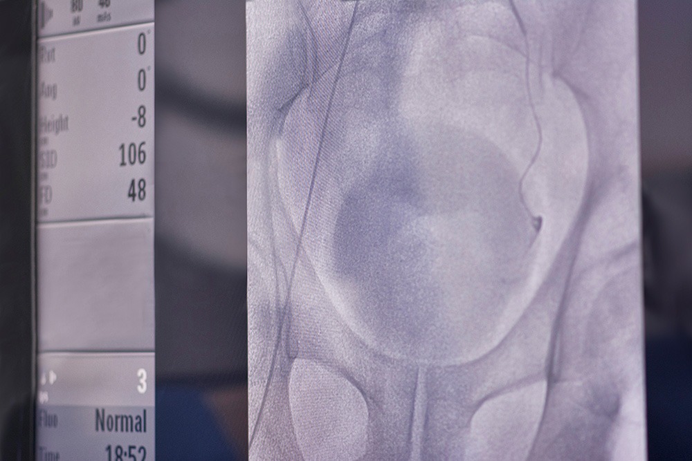 Prostate Artery Embolization (PAE) in Cary, NC